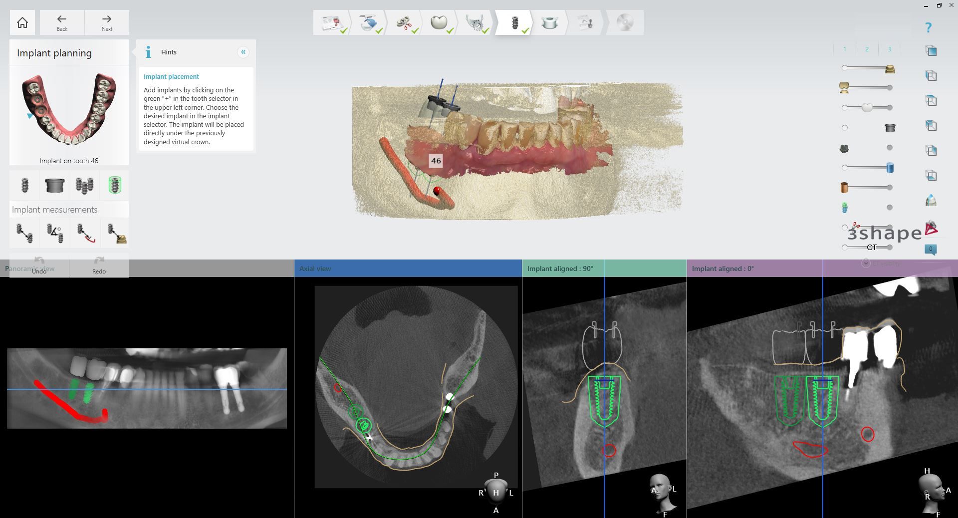 Digital Smiles 3shape Implant Studio Digital Smiles 3shape Implant Studio
